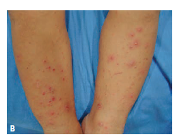 Parasitosis superficiales Flashcards | Memorang