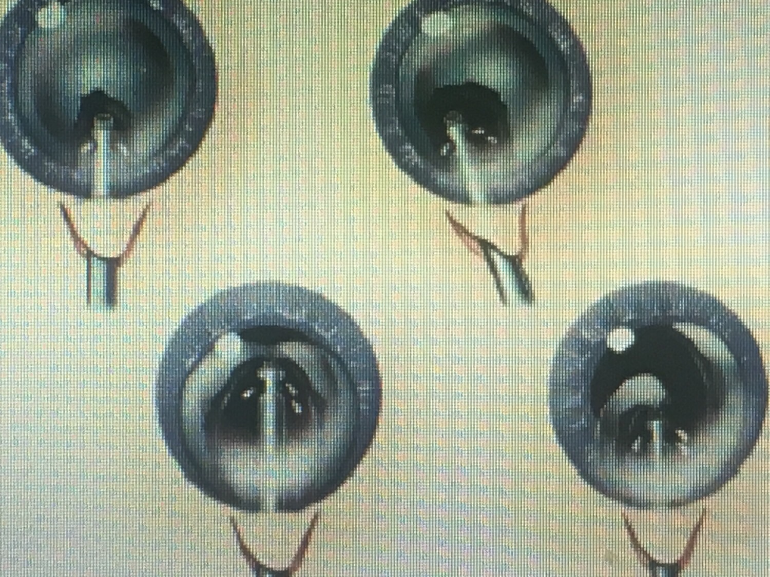 Oftalmo 3 Flashcards | Memorang