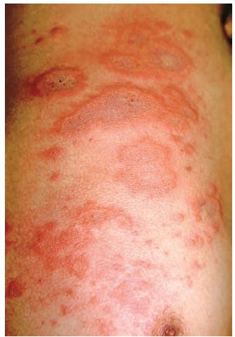 Farmacodermias & Fotodermias. Flashcards | Memorang