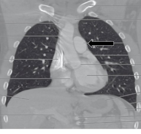 Cardiac/Thoracic Imaging Flashcards | Memorang