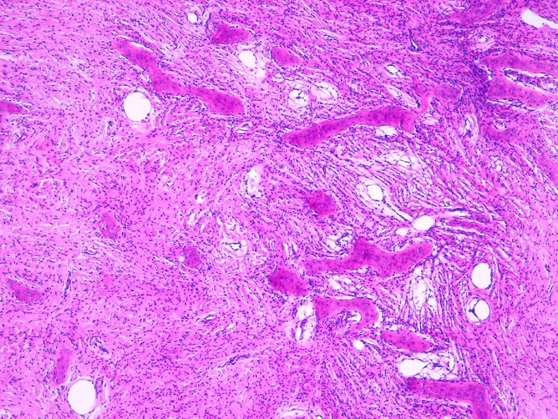 Bones/joints and soft tissue tumours Flashcards | Memorang