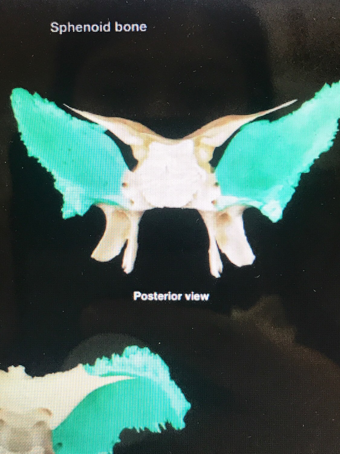 Sphenoid / ethmoid Flashcards | Memorang