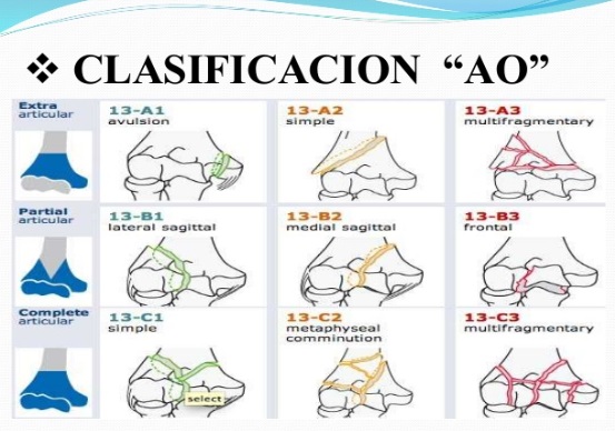 FRACTURAS DEL TERCIO DISTAL DEL HUMERO DIAPOS Flashcards | Memorang