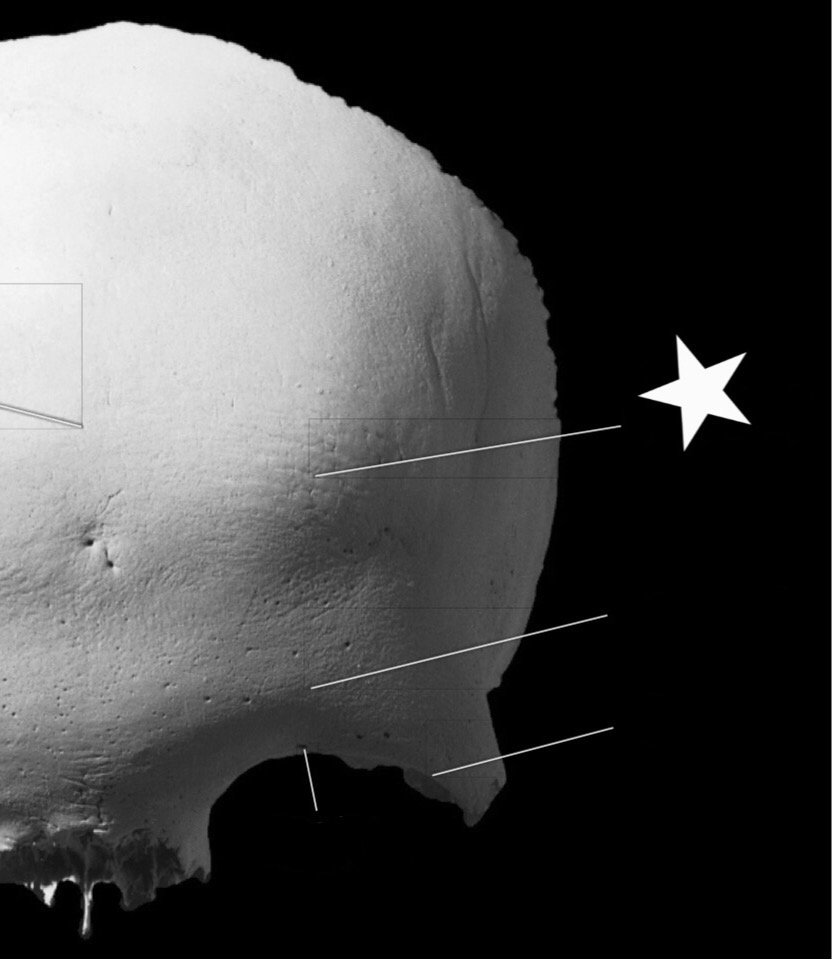 Skeleton: The Frontal Bone Flashcards | Memorang