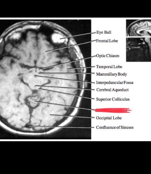 Brain scans part 2 Flashcards | Memorang