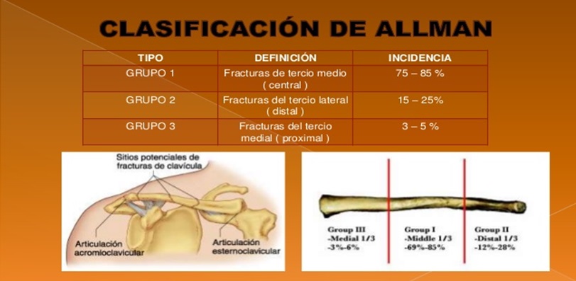 FRACTURA DE CLAVÍCULA DIAPOS Flashcards | Memorang