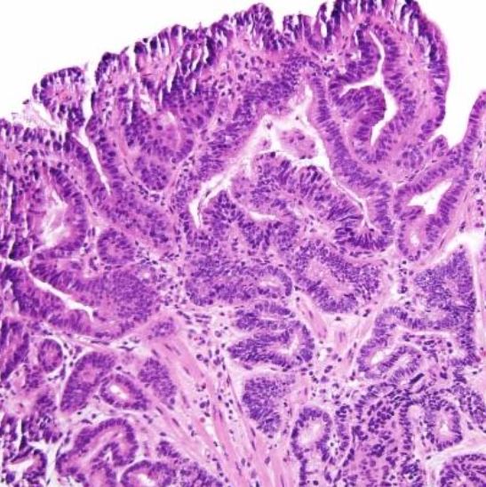 Barret's Esophagus Flashcards | Memorang