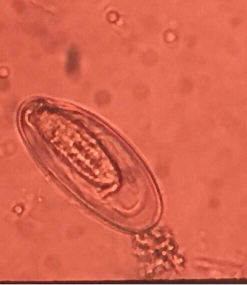 Enterobius Flashcards | Memorang