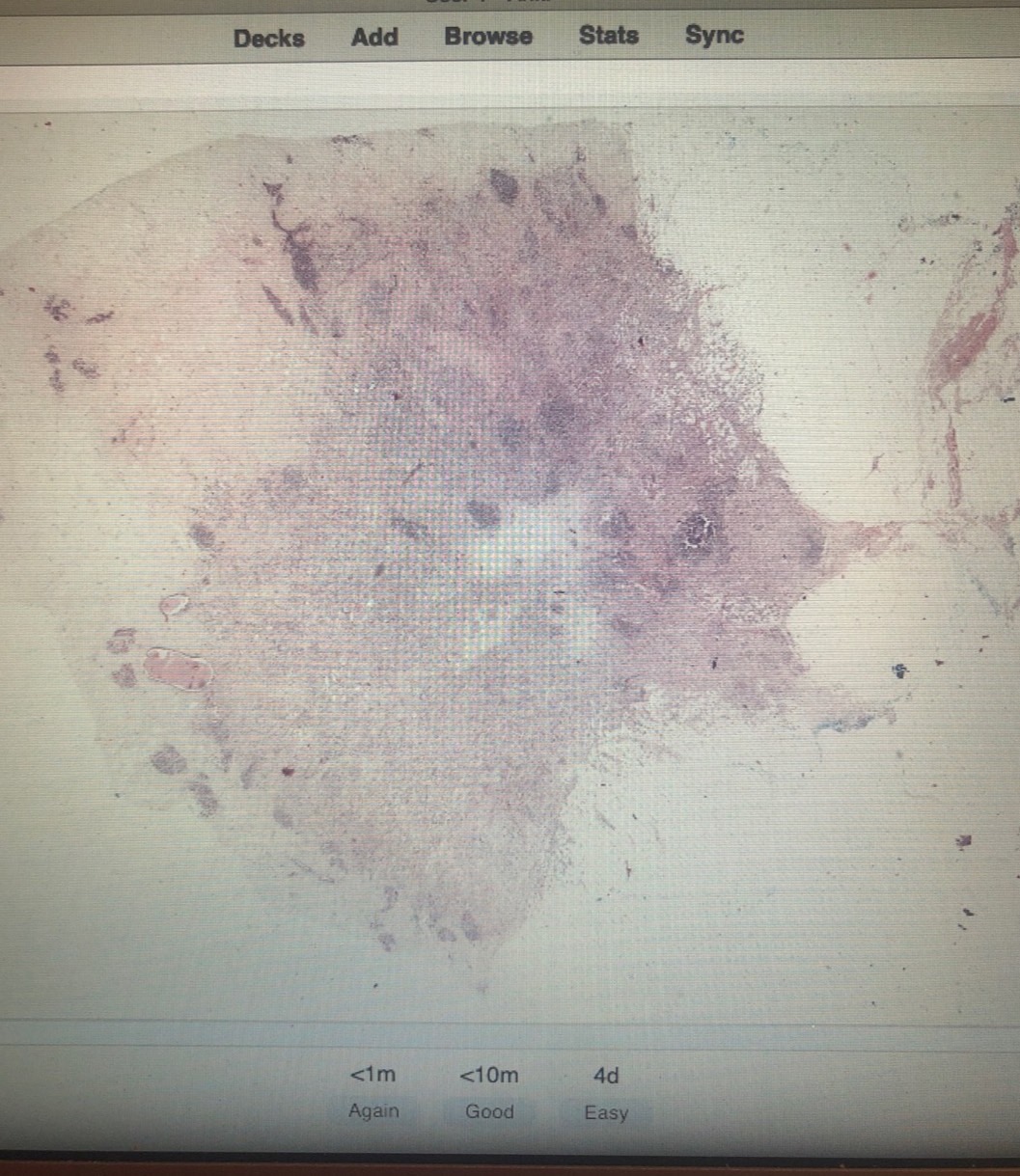 Patho deck 3 Flashcards | Memorang