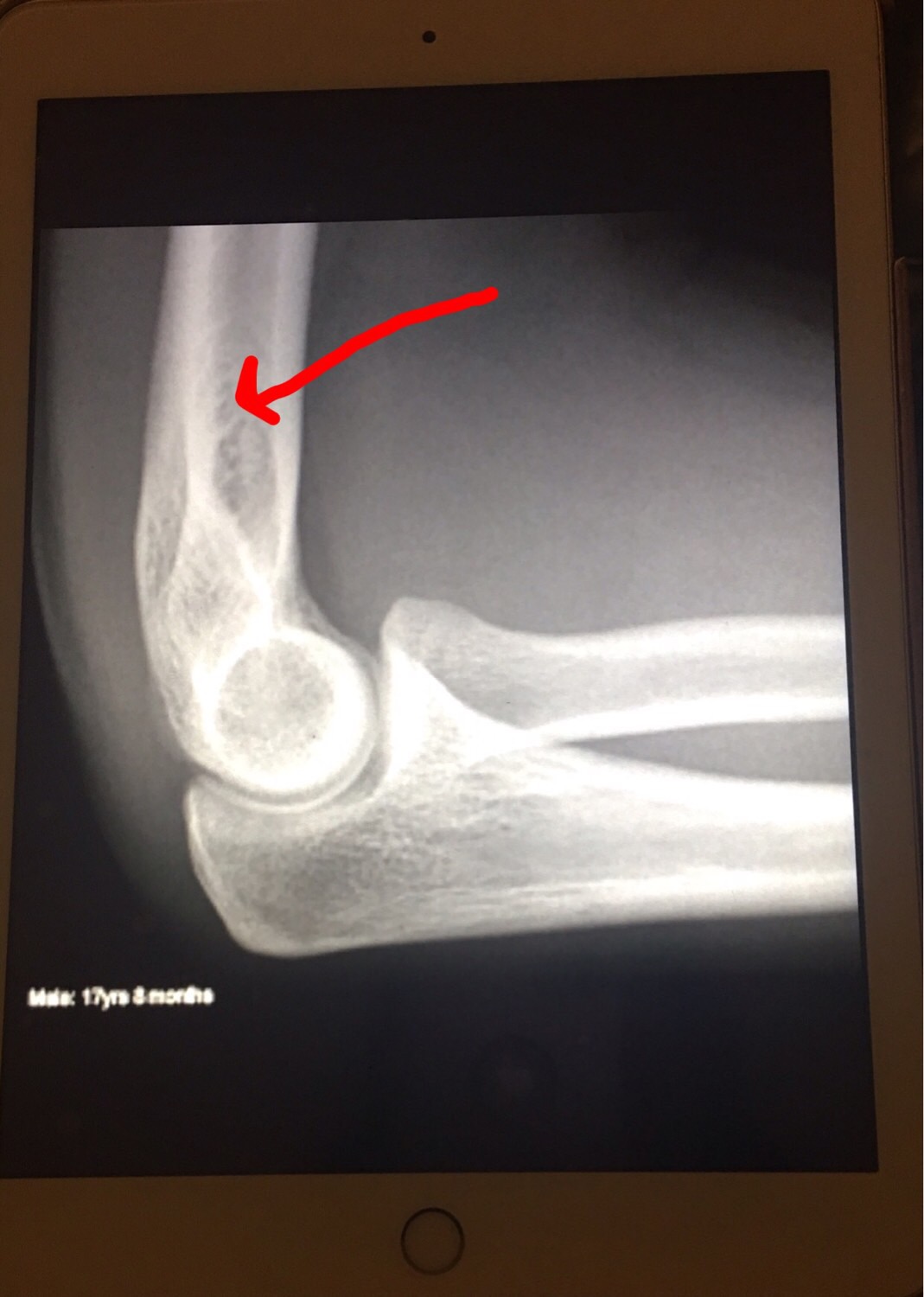 The Elbow Joint 1 Flashcards | Memorang