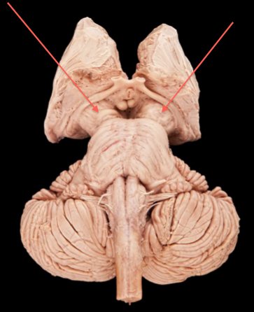 MESENCEPHALON Flashcards | Memorang