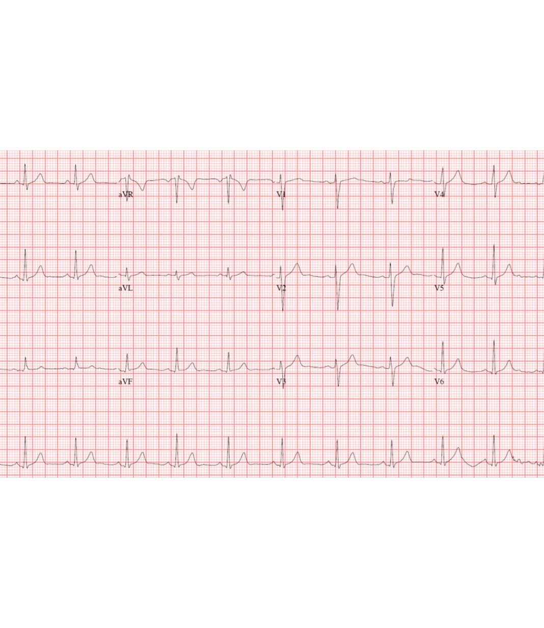 ECG Flashcards | Memorang