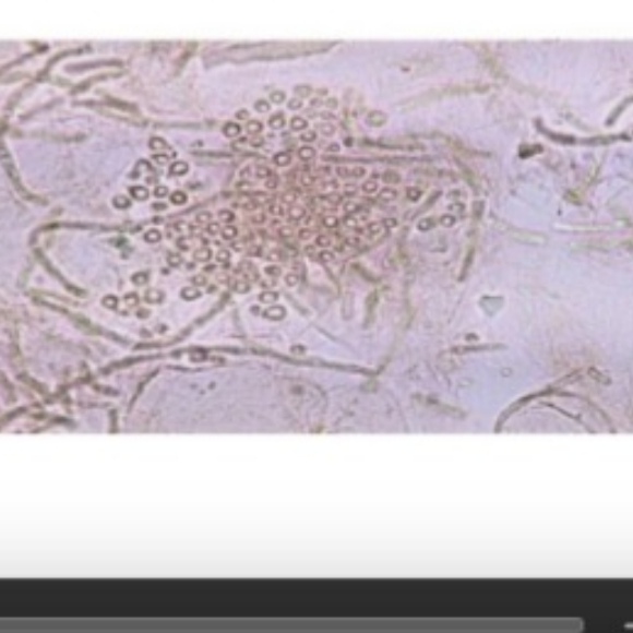 Micosis Flashcards | Memorang