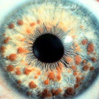 Ophthalmologytoday Flashcards | Memorang