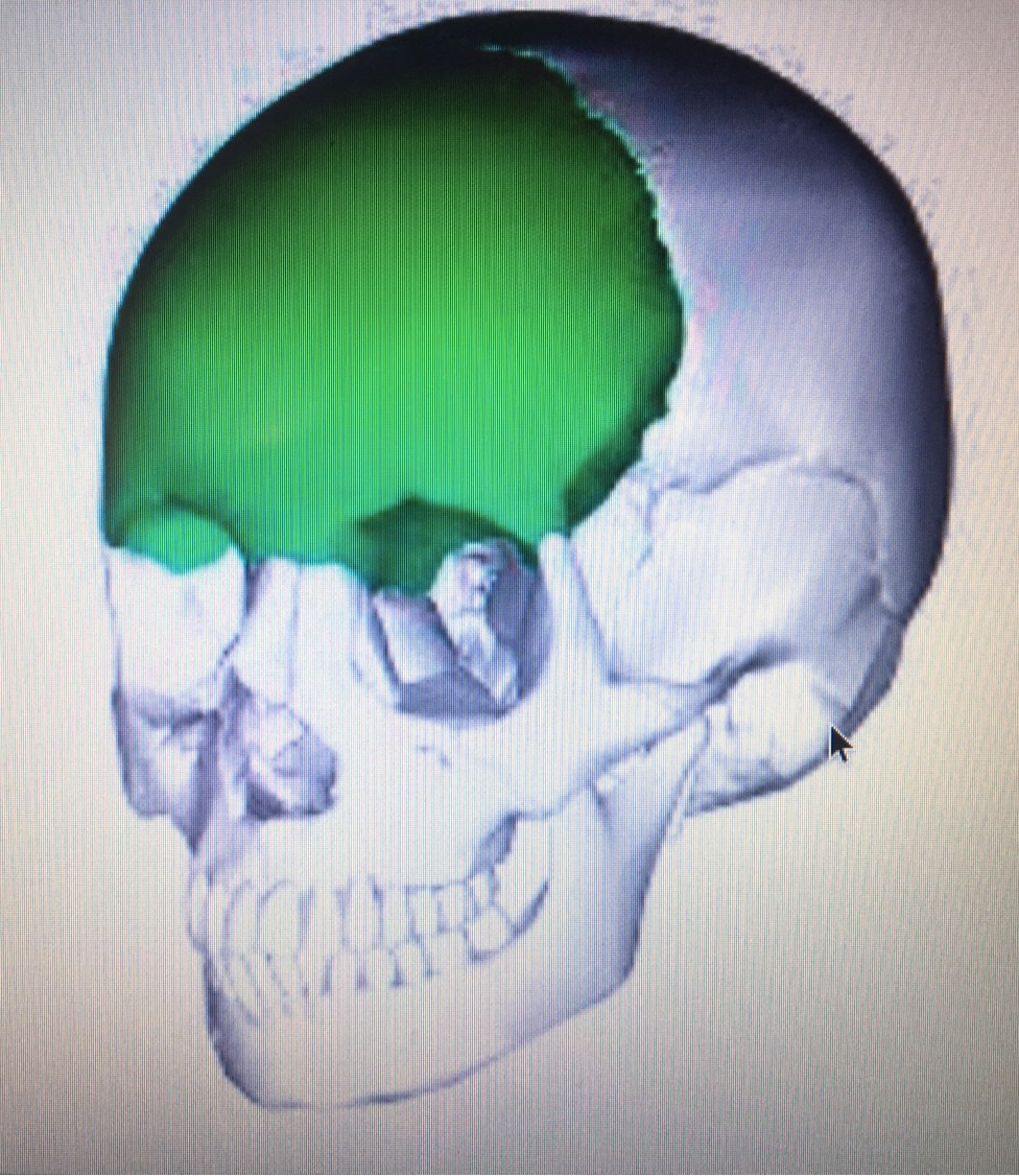 A&P SKULL bones, processes, foramen and sutures Flashcards | Memorang