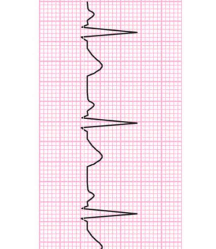 EKG Flashcards | Memorang