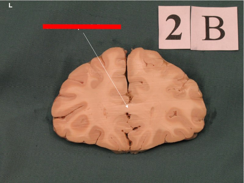 Coronal Brain Sections Flashcards | Memorang