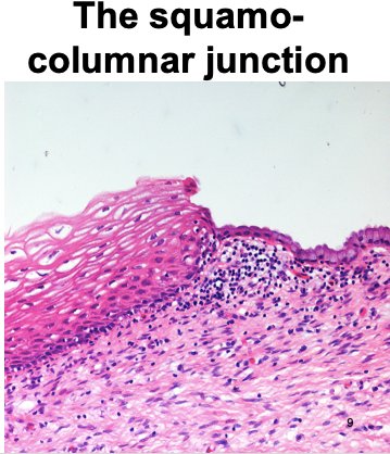 203 - 3: PC: Pathology of the Female Genital Flashcards | Memorang